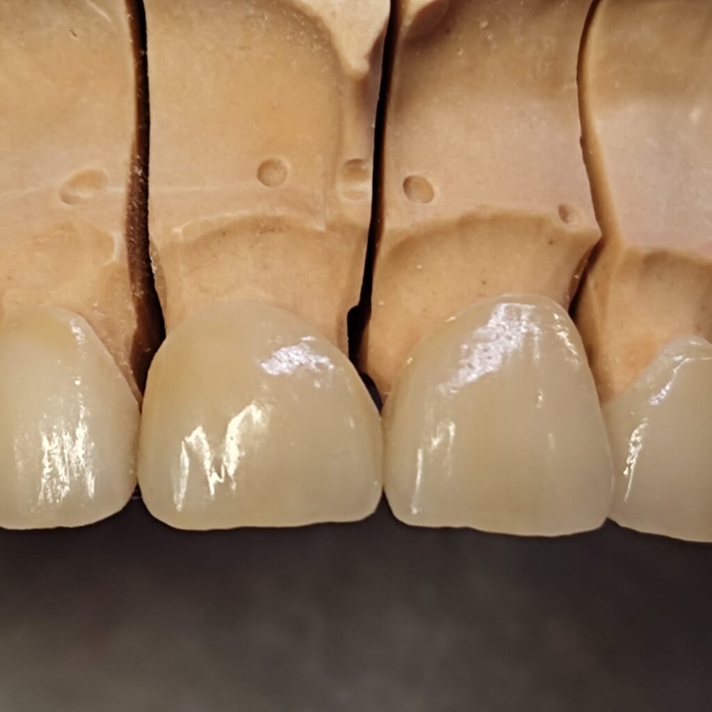Zirconio estratificado - Laboratorio Dental Milla