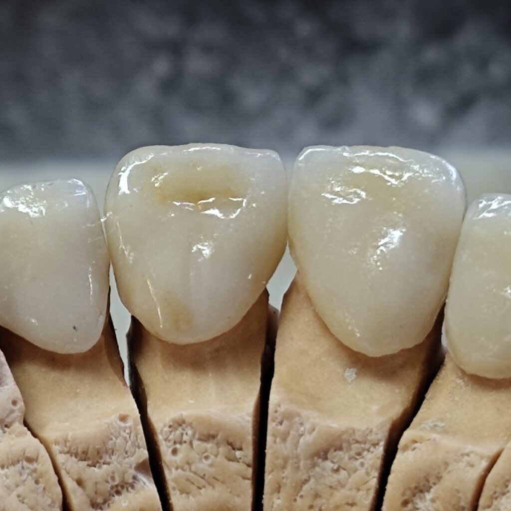 Zirconio estratificado - Laboratorio Dental Milla